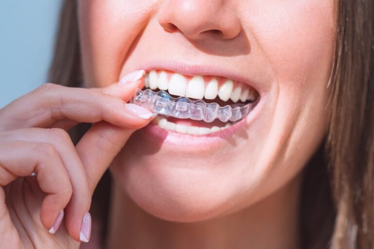 How to Remove Your Clear Aligners | Westside Dental Associates